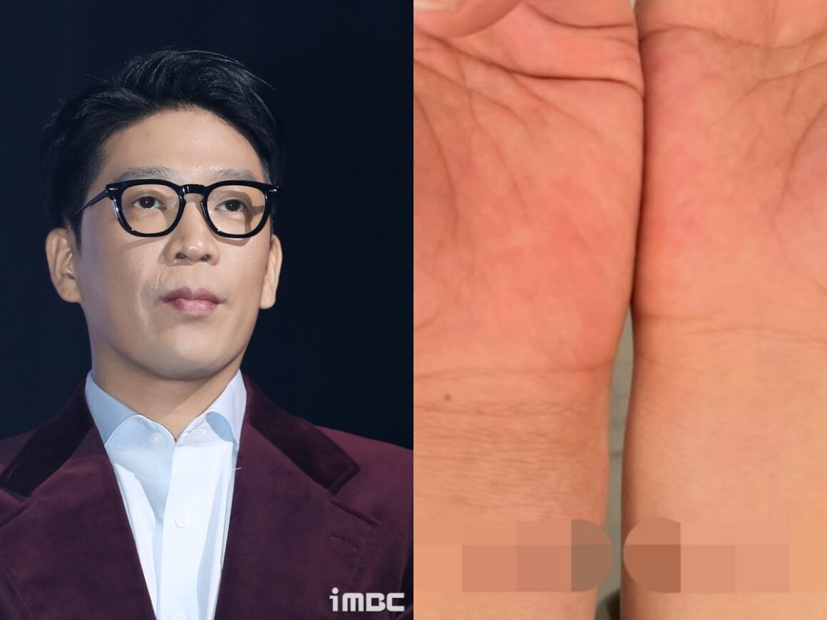 MC Mong Reveals Disturbing Photos of Wrist Injuries, Addresses Hitler ...